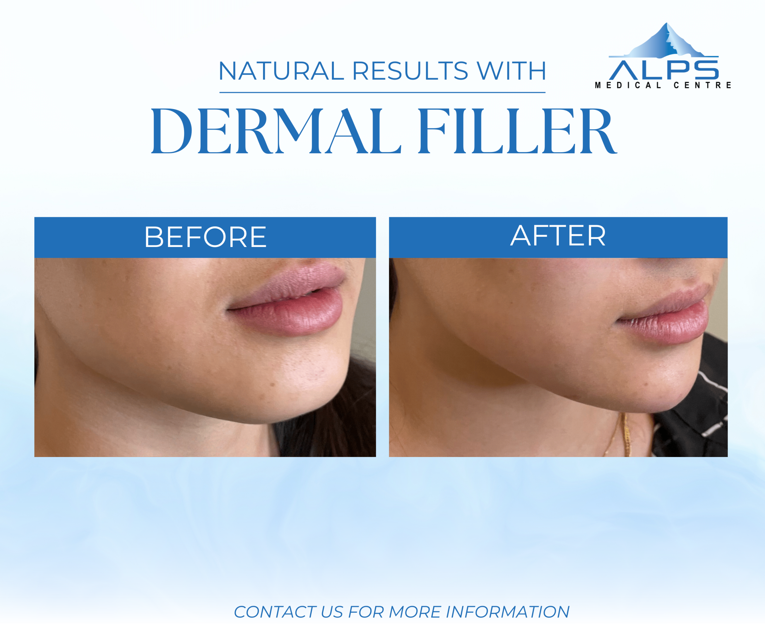 Dermal Filler | ALPS Medical