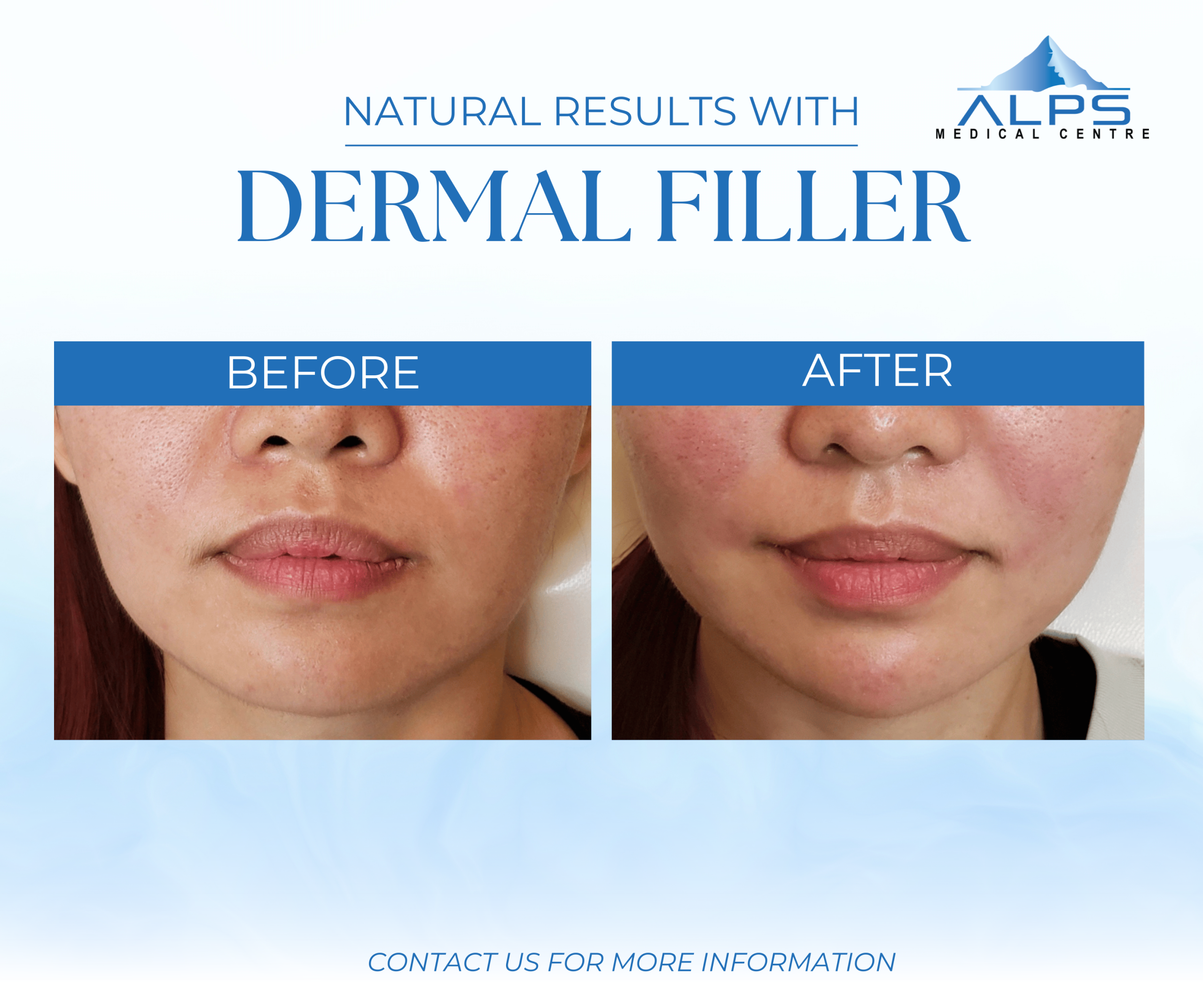 Dermal Filler | ALPS Medical
