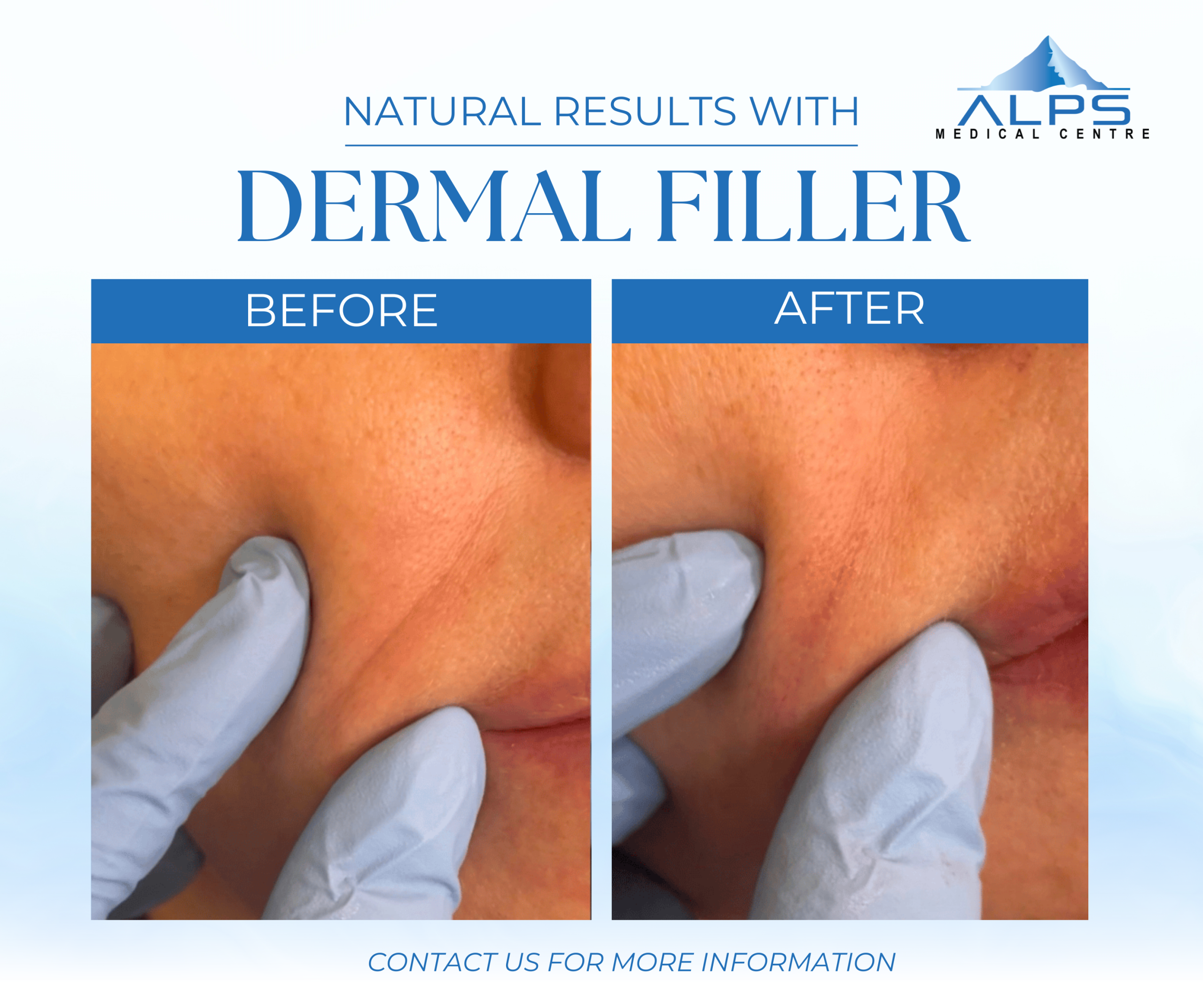 Dermal Filler | ALPS Medical
