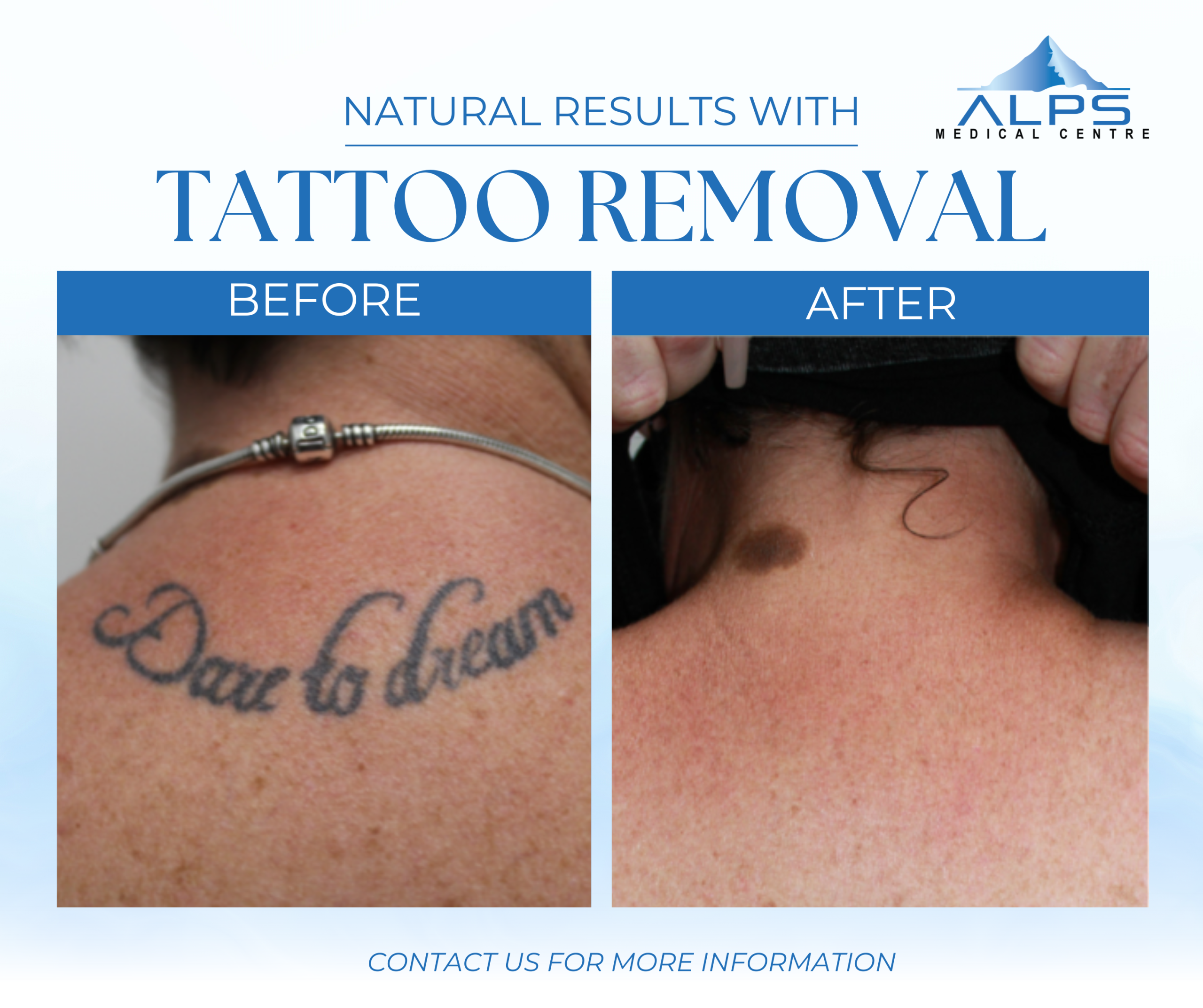 Tattoo Removal | ALPS Medical
