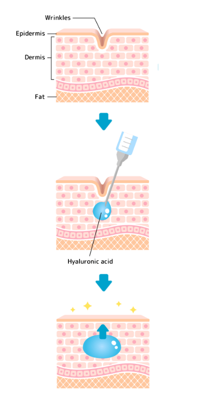 Skin Booster | ALPS Medical