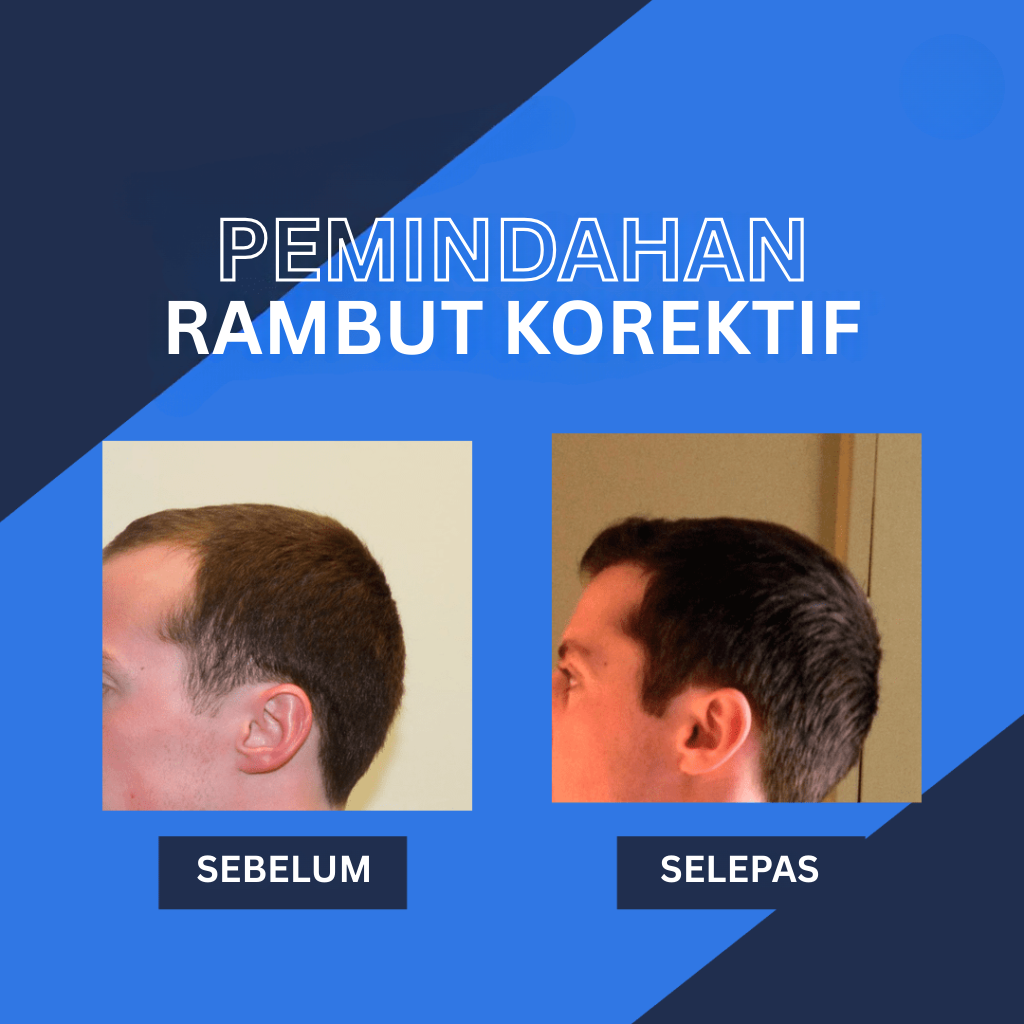 Pakar Tanam Rambut Malaysia | ALPS Medical Centre